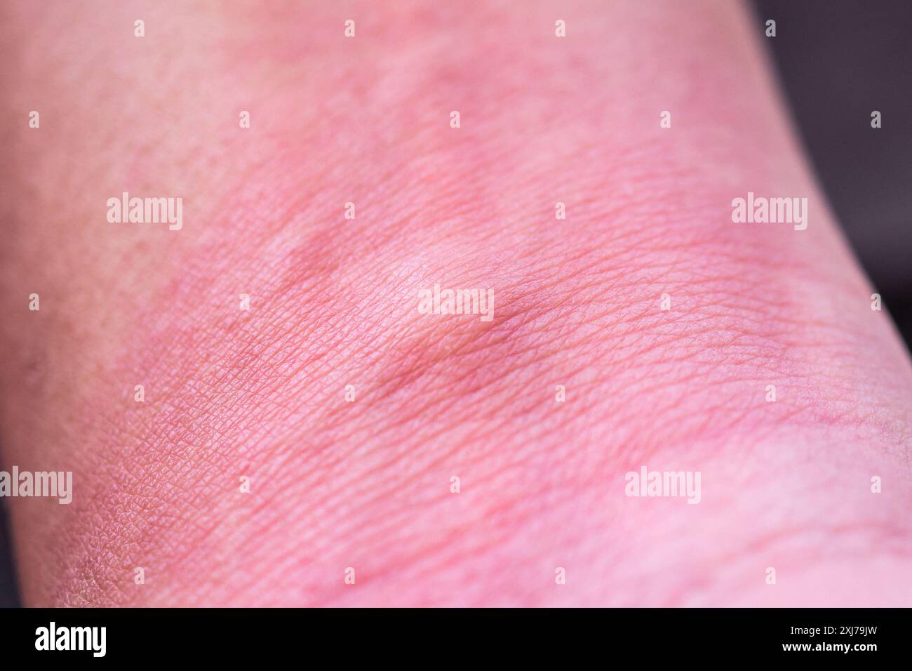 skin allergy with rash after mosquito bite Stock Photo - Alamy