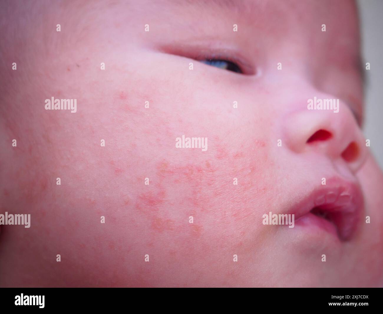newborn baby with dermatitis allergy on face Stock Photo - Alamy
