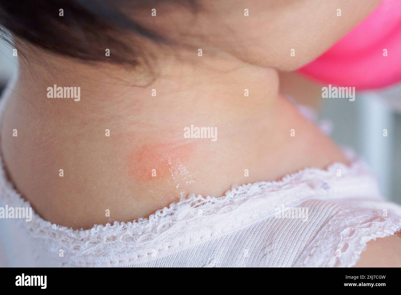 baby skin rash and allergy with red spot cause by mosquito bite at neck ...