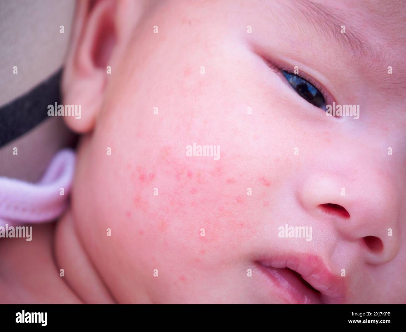 newborn baby with dermatitis allergy on face Stock Photo - Alamy