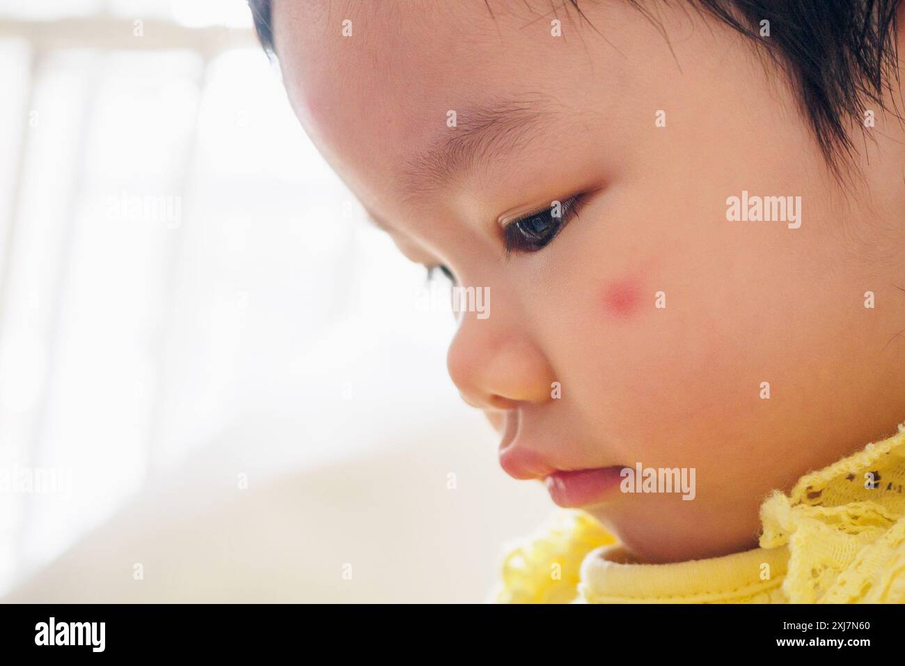 Cute little asian girl with allergy red spot face cause by insect bite ...