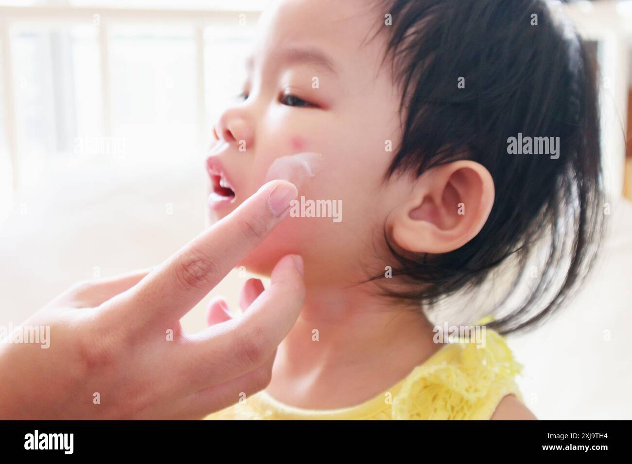 Insect bites face woman hi-res stock photography and images - Alamy