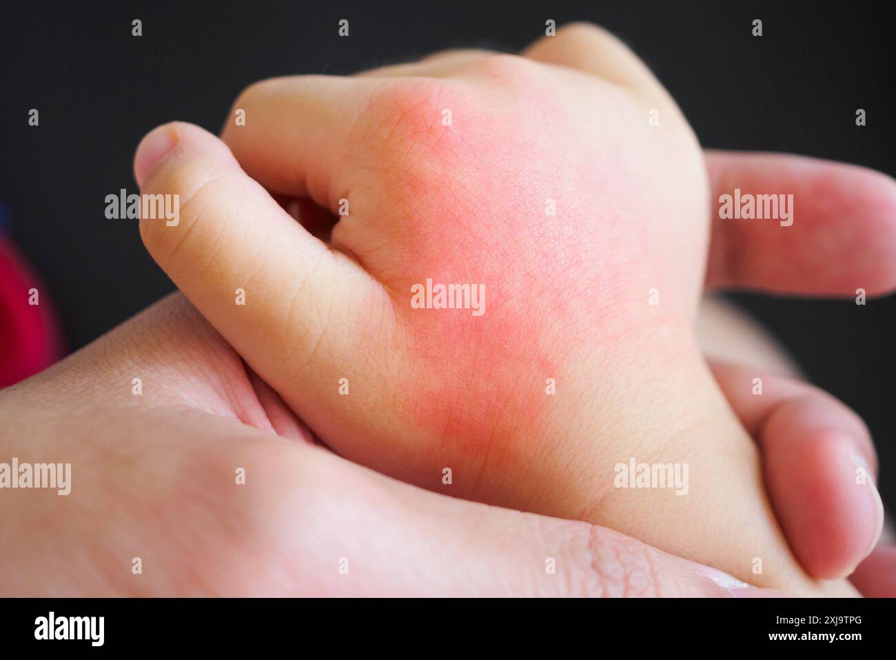 baby hand with skin rash and allergy with red spot cause by mosquito ...