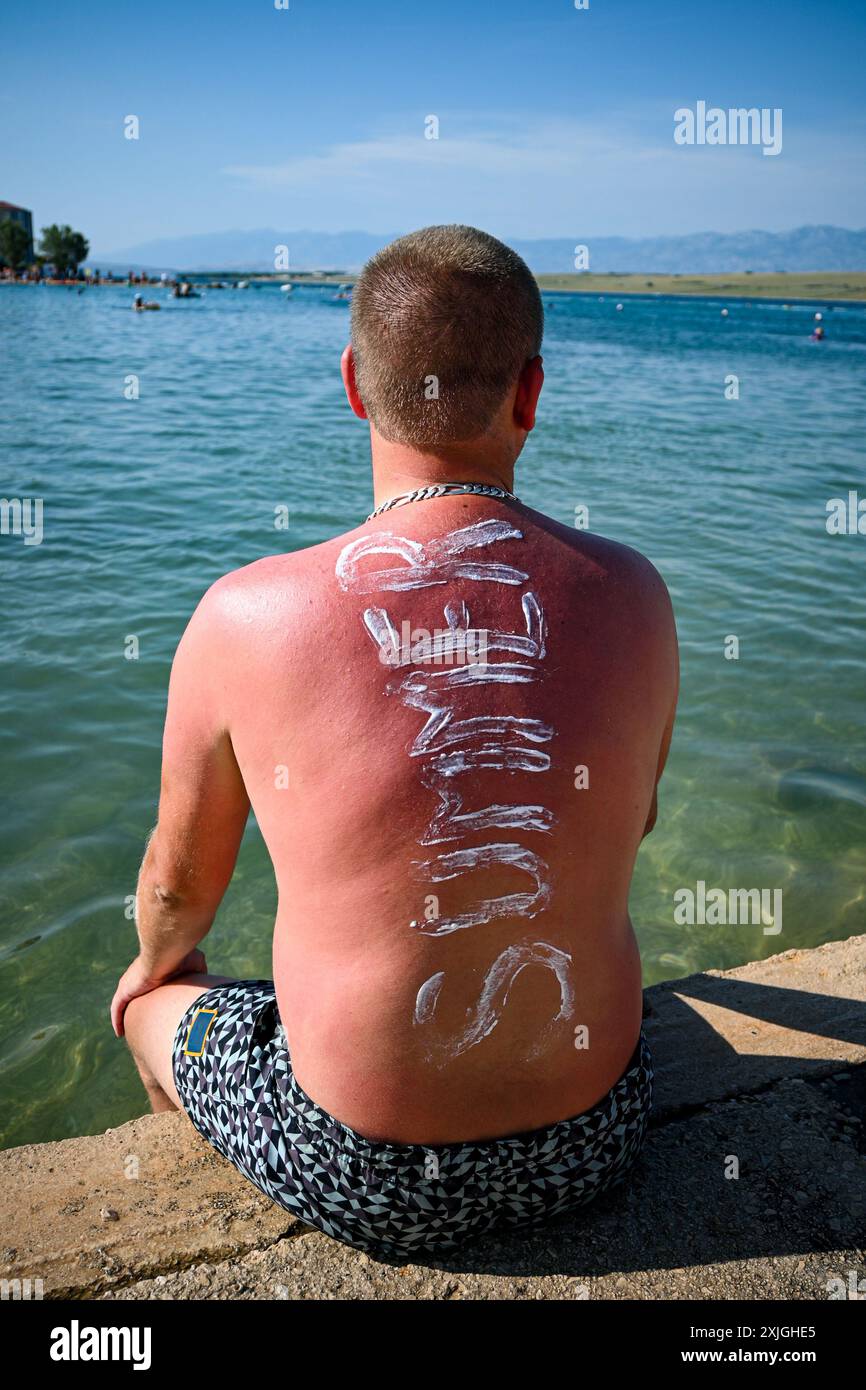 Sunburn man hi-res stock photography and images - Alamy
