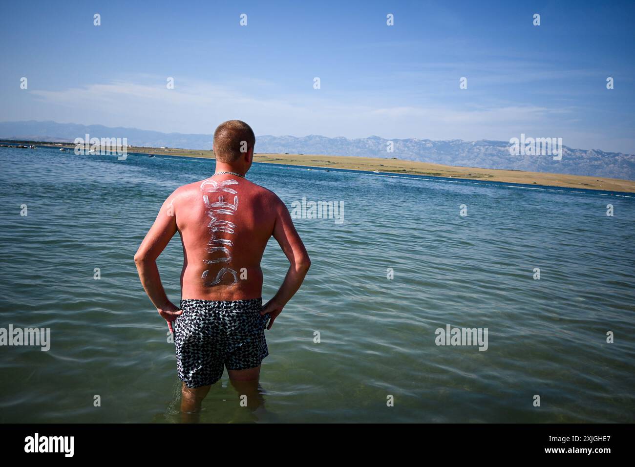 Man with sunburn on his back, standing in the water, with the word ...