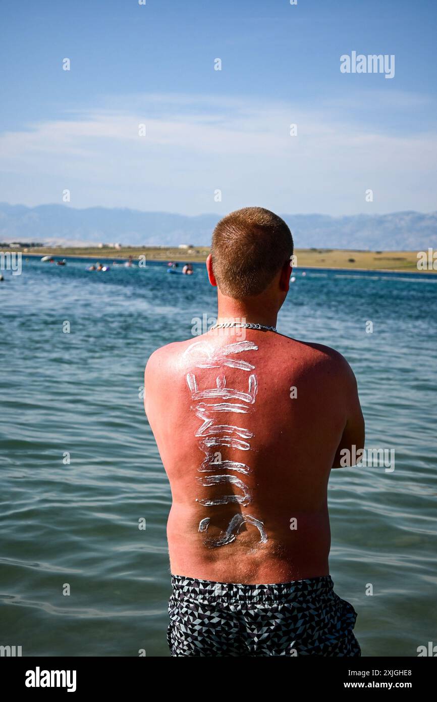 Man with sunburn on his back, standing in the water, with the word ...