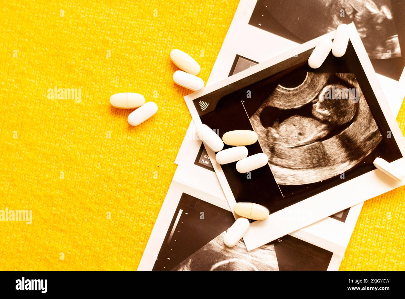 Photos of the fetus on ultrasound scan and few pills on yellow ...