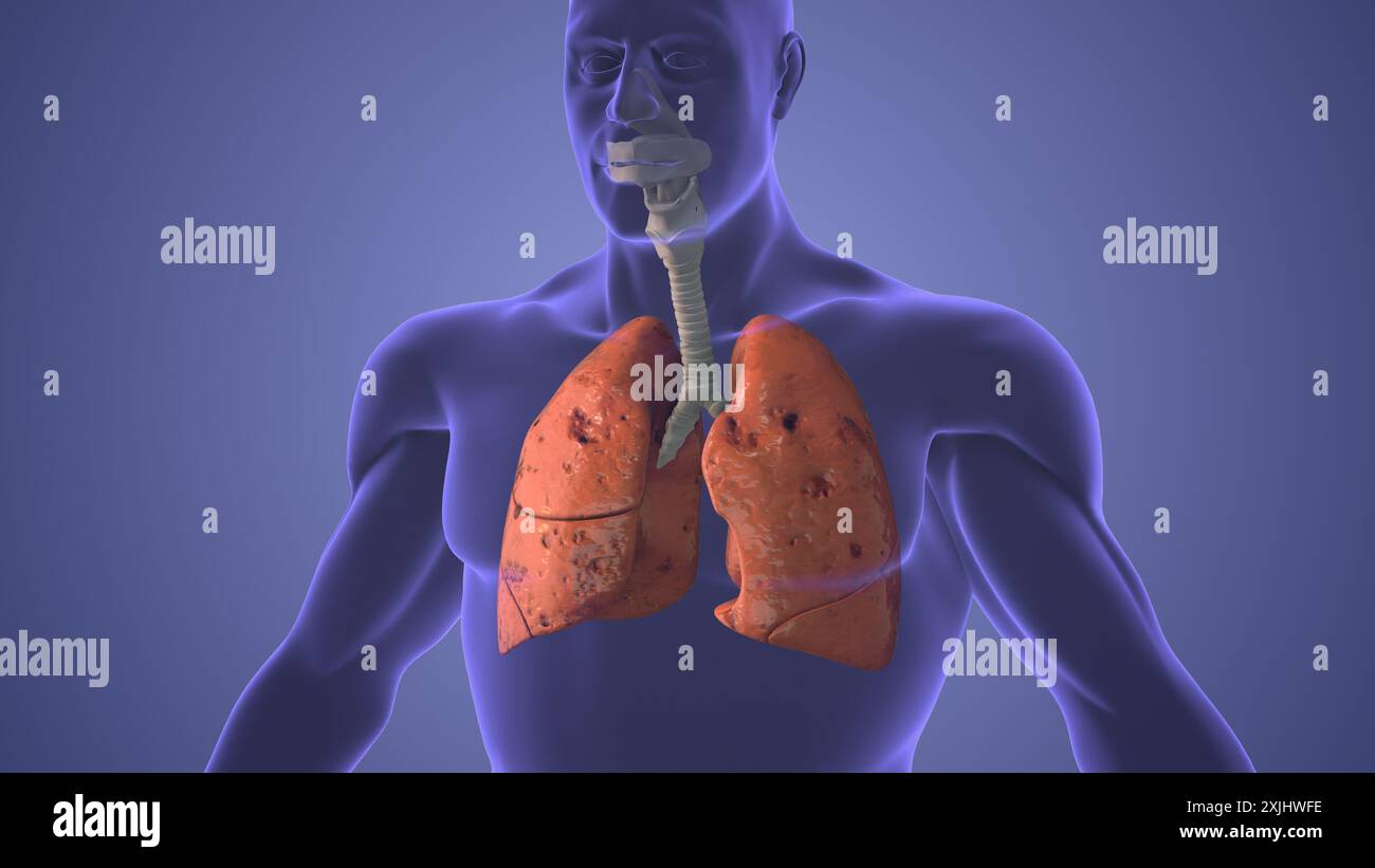 Pneumothorax hemothorax hi-res stock photography and images - Alamy