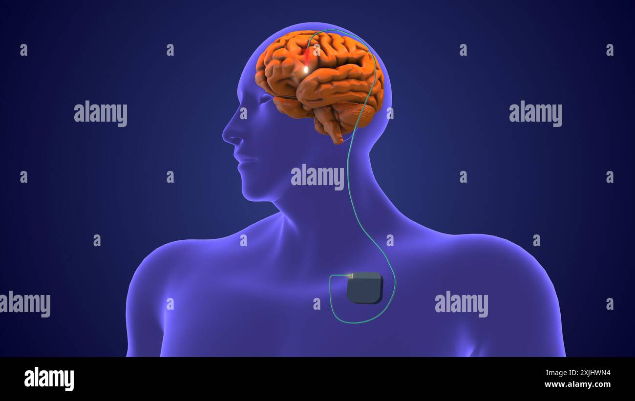 Deep brain stimulation medical concept Stock Photo - Alamy Deep brain stimulation medical concept Stock Photo - Alamy