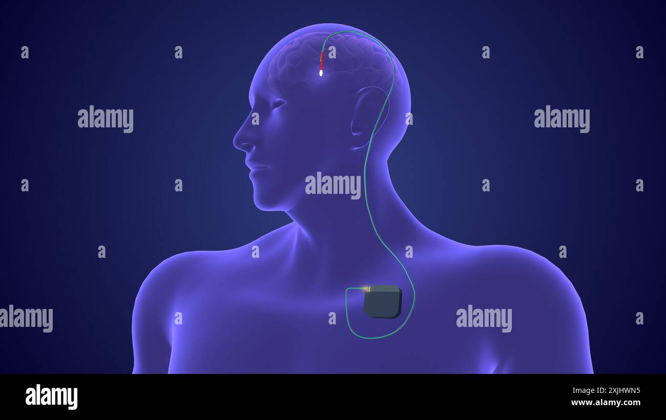 Transcranial magnetic stimulation hi-res stock photography and images ...