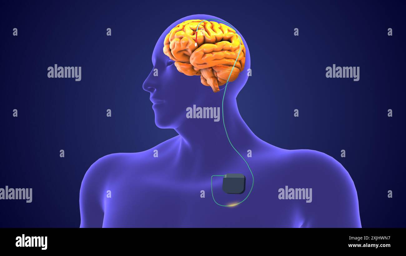Deep brain stimulation medical concept Stock Photo - Alamy