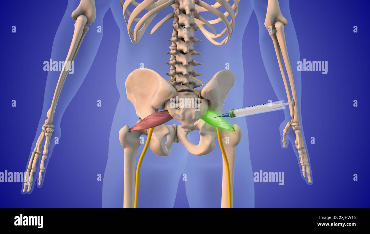 Injecting steroids to treat Piriformis Syndrome Stock Photo - Alamy