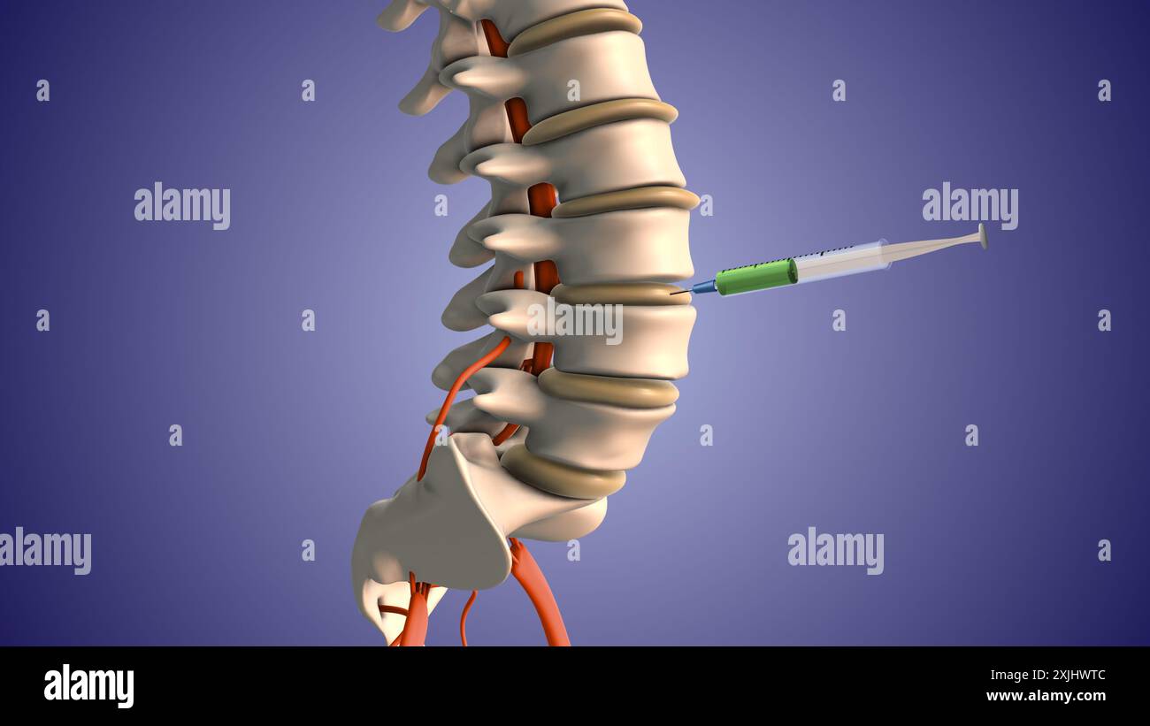 Herniated disc hi-res stock photography and images - Alamy