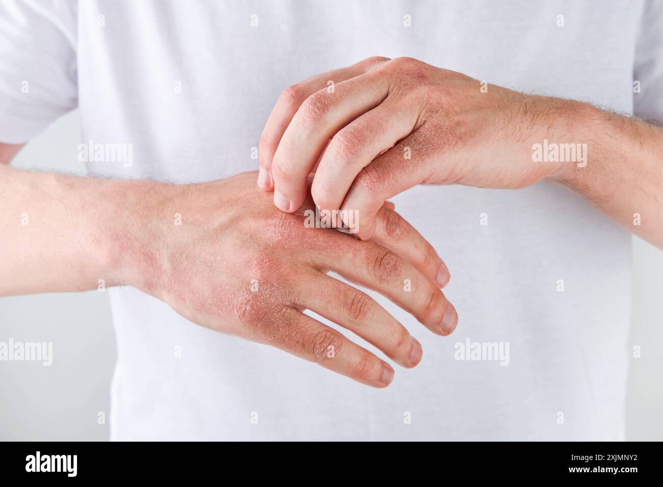 Man scratches or shows hands with dry, cracked skin on white ...