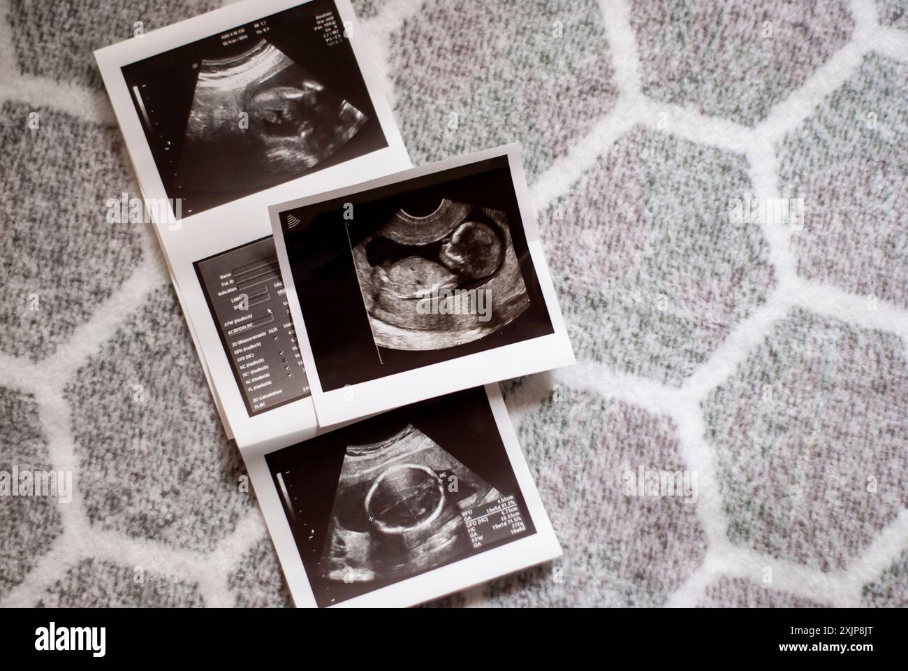 Ultrasound results of pregnancy. Photo of fetus. Expectation of child ...