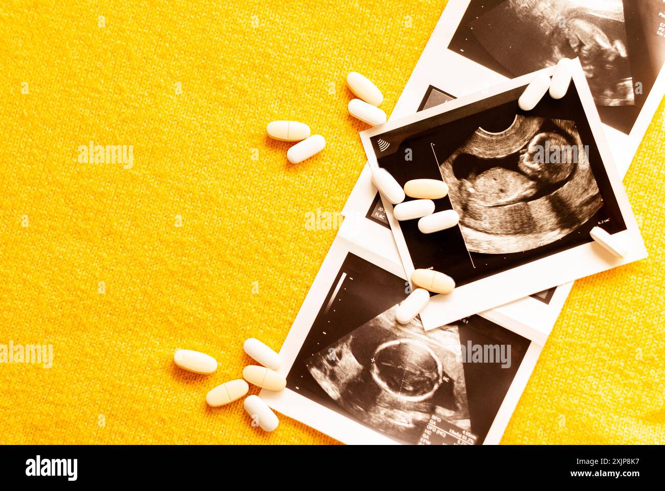 Photos of fetus on ultrasound scan and pills on yellow back ...