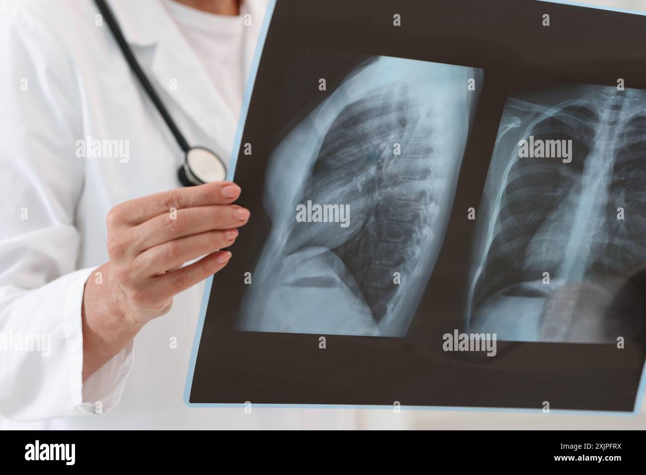 Lung disease. Doctor examining chest x-ray in clinic, closeup Stock ...