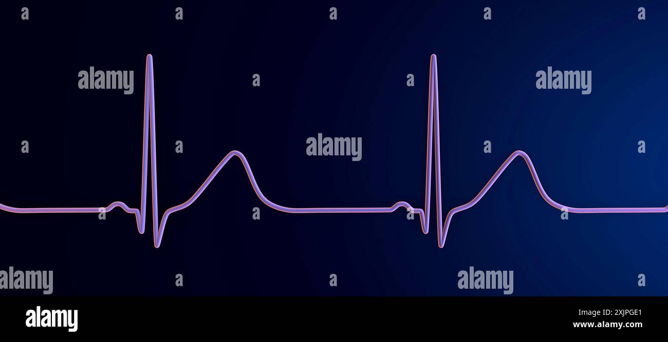 Illustration of an electrocardiogram (ECG) showing a prolonged QT ...