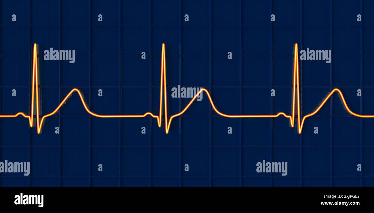 Illustration of an electrocardiogram (ECG) showing a prolonged QT ...