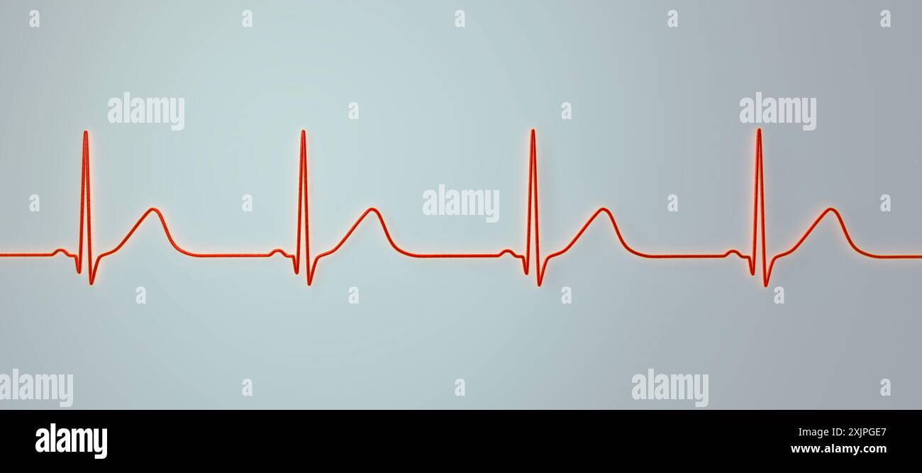 Illustration of an electrocardiogram (ECG) showing a prolonged QT ...