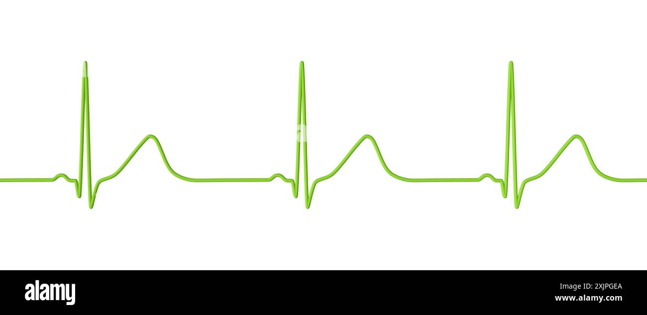 Long qt syndrome electrocardiogram hi-res stock photography and images ...