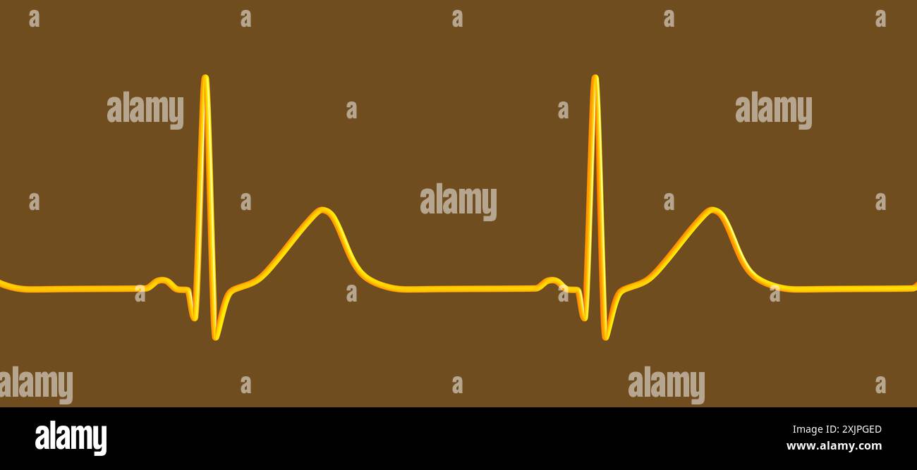 Illustration of an electrocardiogram (ECG) showing a prolonged QT ...
