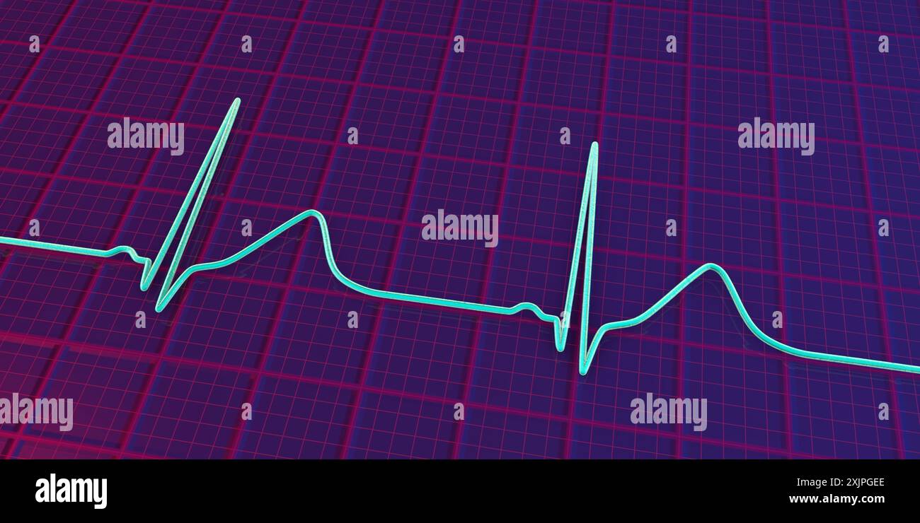 Illustration of an electrocardiogram (ECG) showing a prolonged QT ...