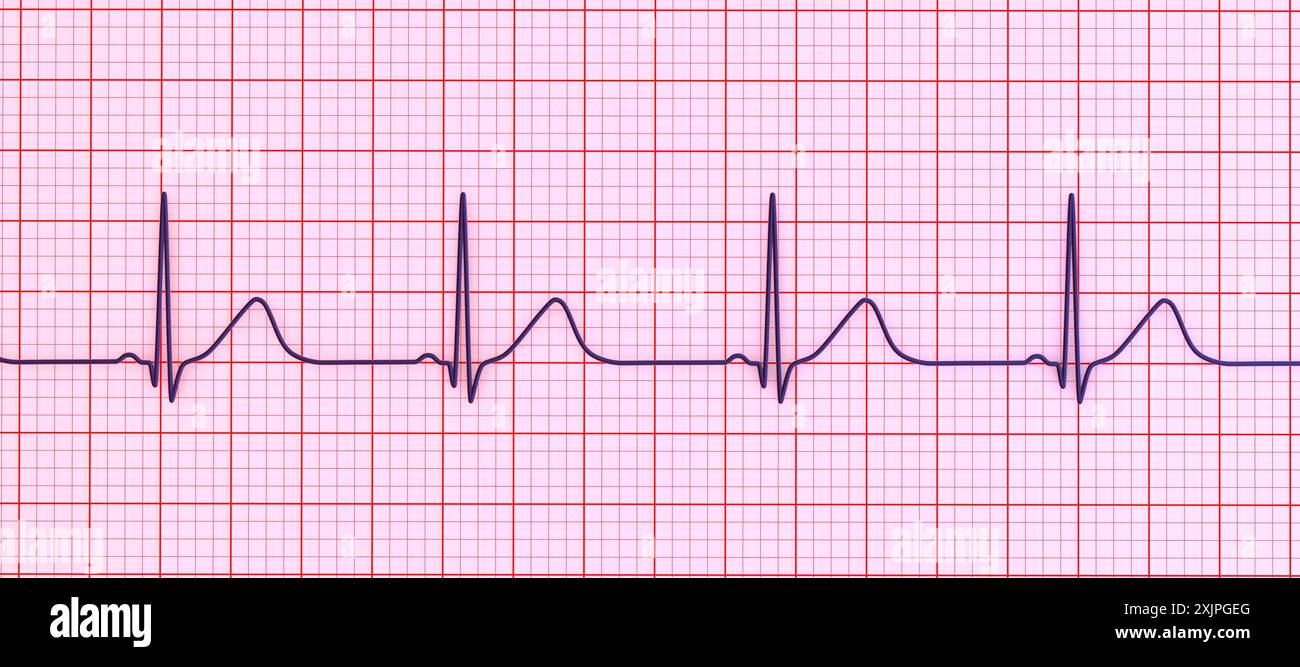 Illustration of an electrocardiogram (ECG) showing a prolonged QT ...