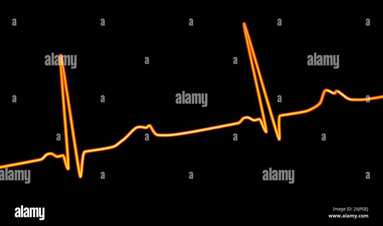 Long qt syndrome type 2 electrocardiogram hi-res stock photography and ...