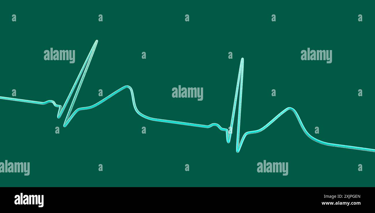 Long qt syndrome type 1 electrocardiogram hi-res stock photography and ...