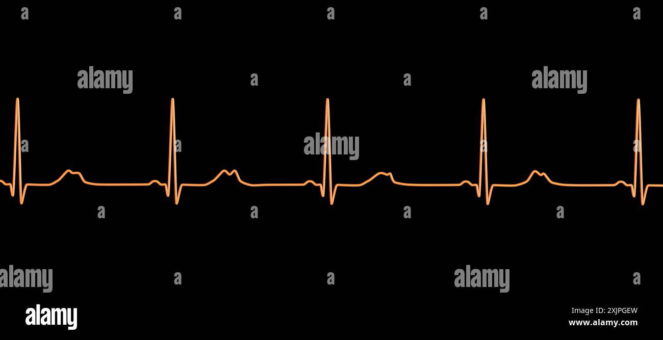 Illustration of an electrocardiogram (ECG) showing prolonged QT ...