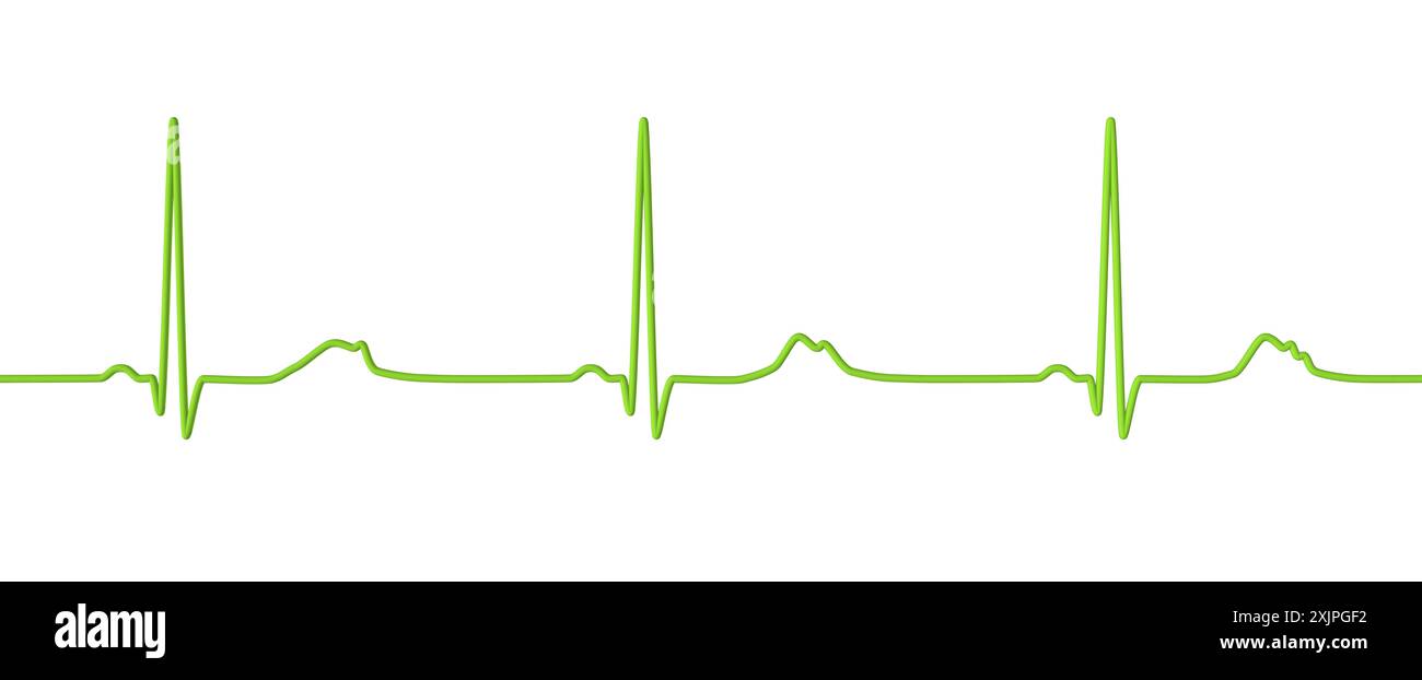 Illustration of an electrocardiogram (ECG) showing prolonged QT ...