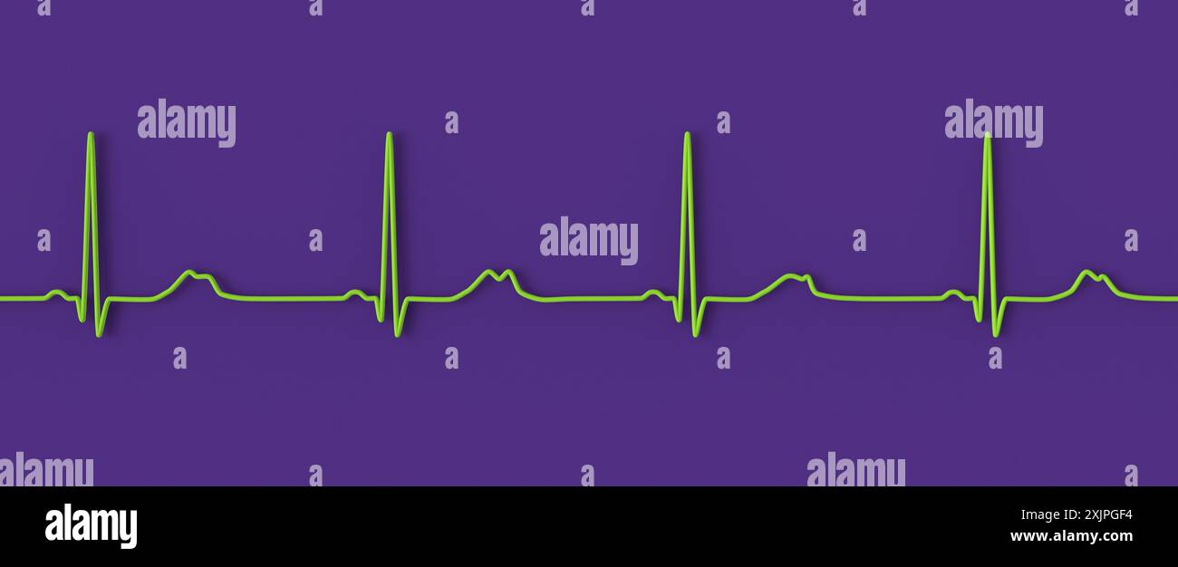 Illustration of an electrocardiogram (ECG) showing prolonged QT ...