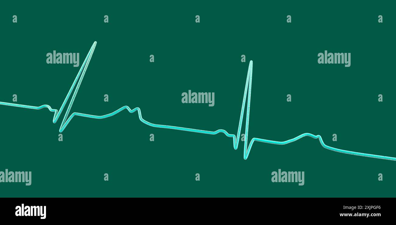 Illustration of an electrocardiogram (ECG) showing prolonged QT ...