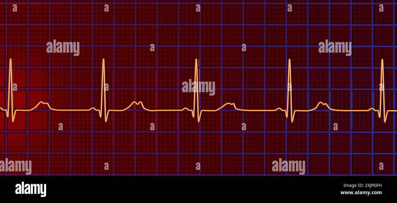 Illustration of an electrocardiogram (ECG) showing prolonged QT ...
