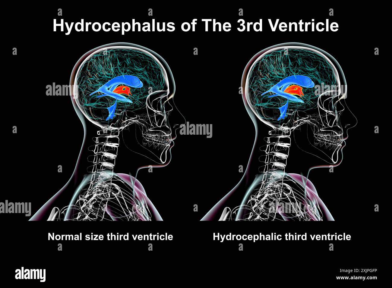 Illustration depicting isolated enlargement of the third brain ventricle (right) compared to the ...