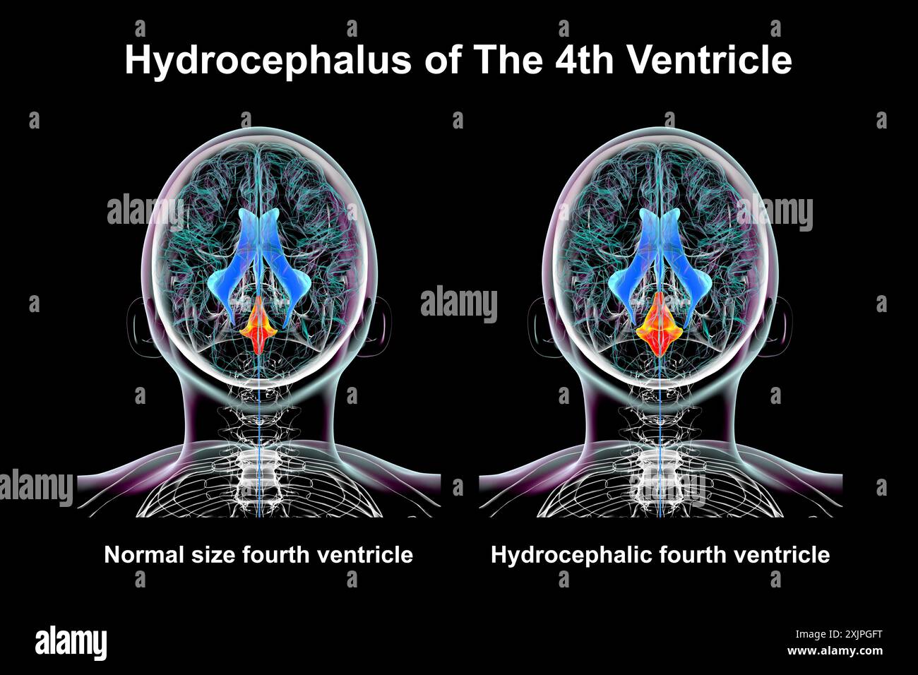 Congenital hydrocephalus hi-res stock photography and images - Alamy