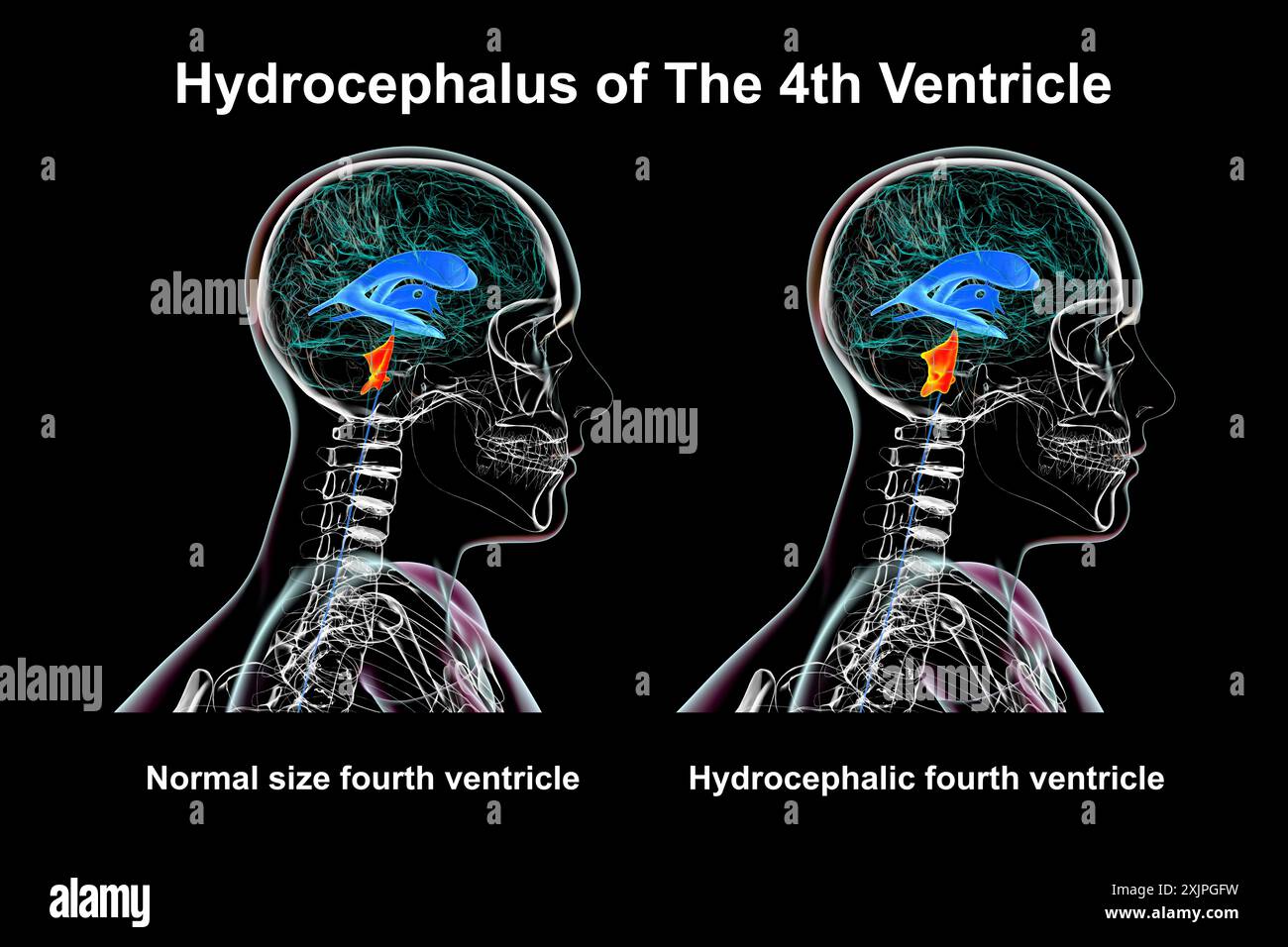 Illustration depicting isolated enlargement of the fourth brain ...