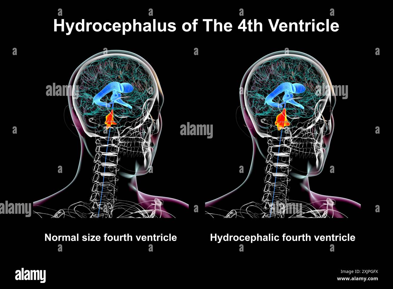 Illustration depicting isolated enlargement of the fourth brain ...