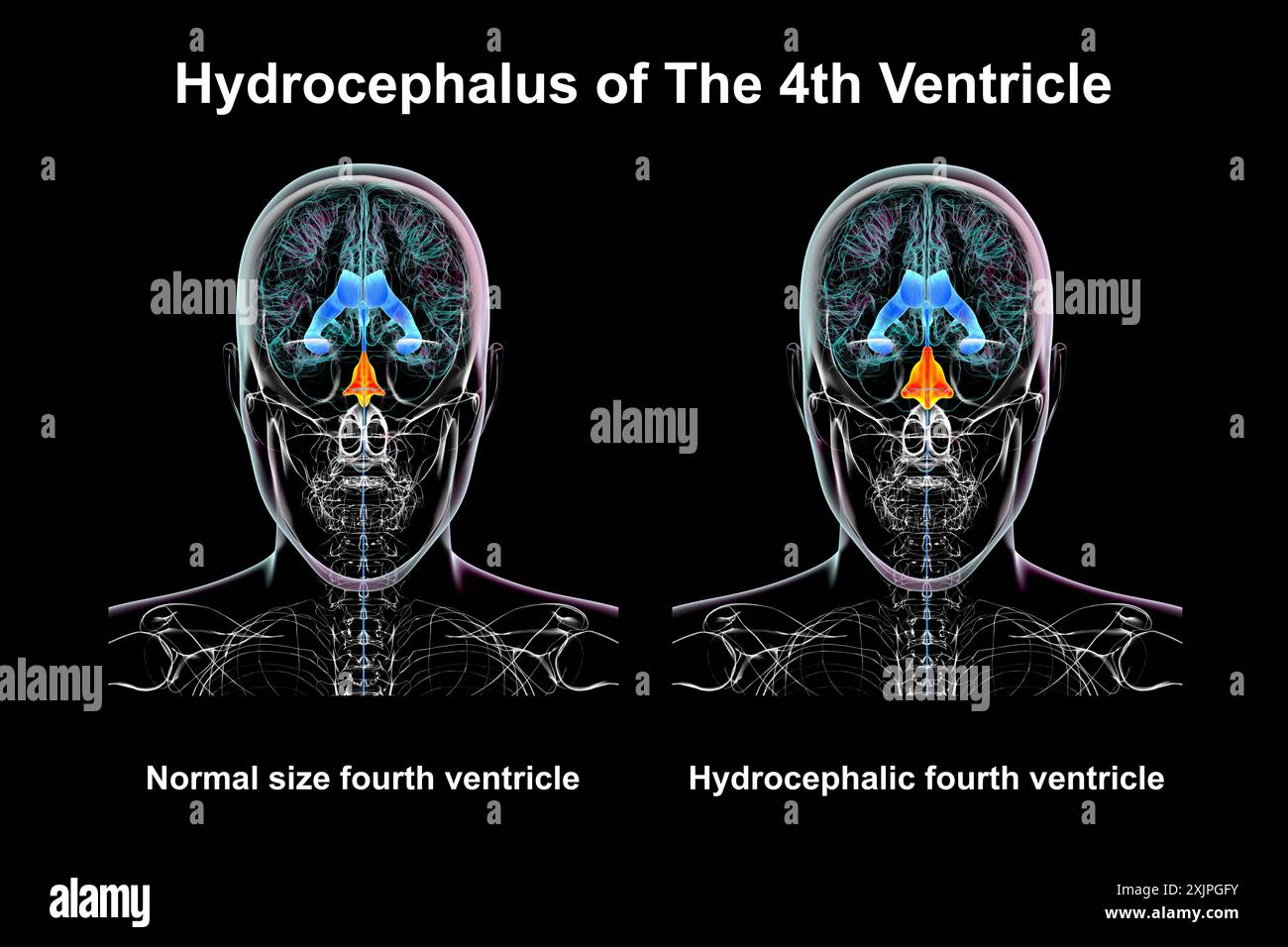 Illustration depicting isolated enlargement of the fourth brain ...