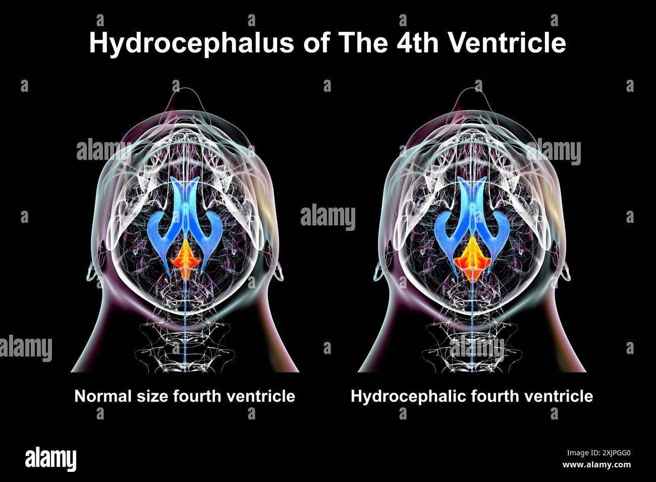 Illustration depicting isolated enlargement of the fourth brain ...