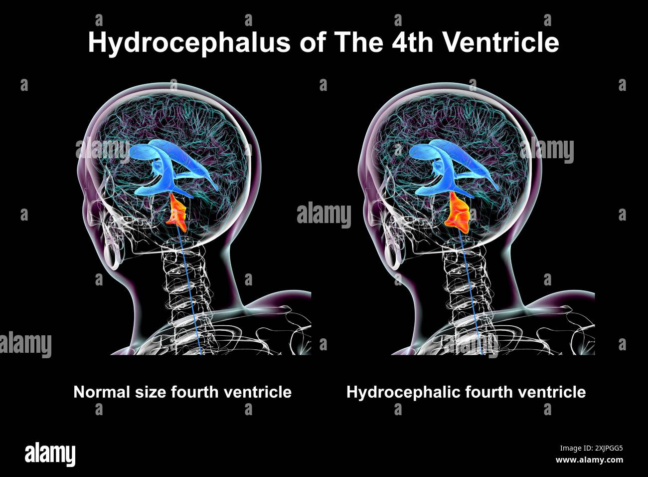 Illustration depicting isolated enlargement of the fourth brain ...
