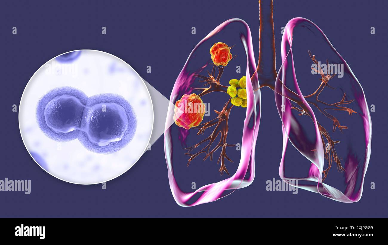 Illustration of pulmonary blastomycosis with lung lesions and enlarged ...