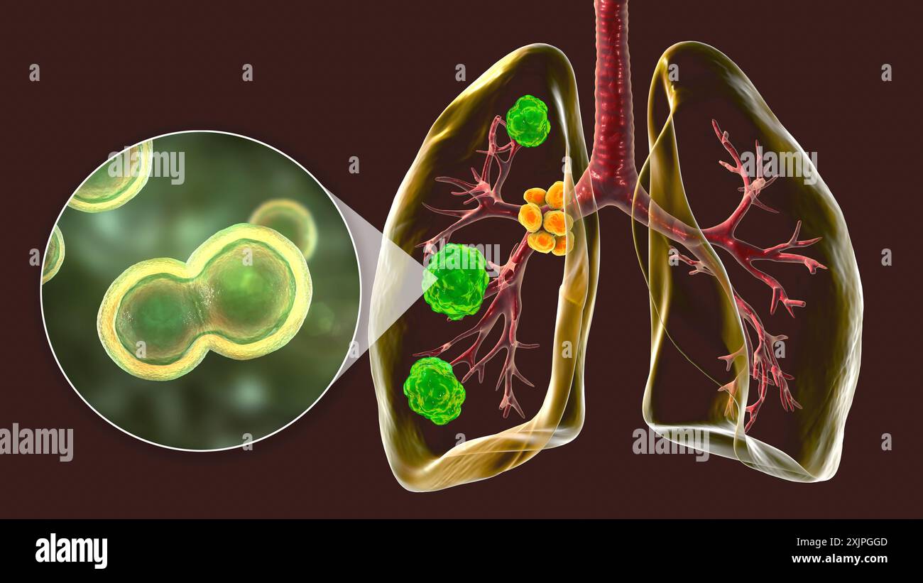 Illustration of pulmonary blastomycosis with lung lesions and enlarged ...