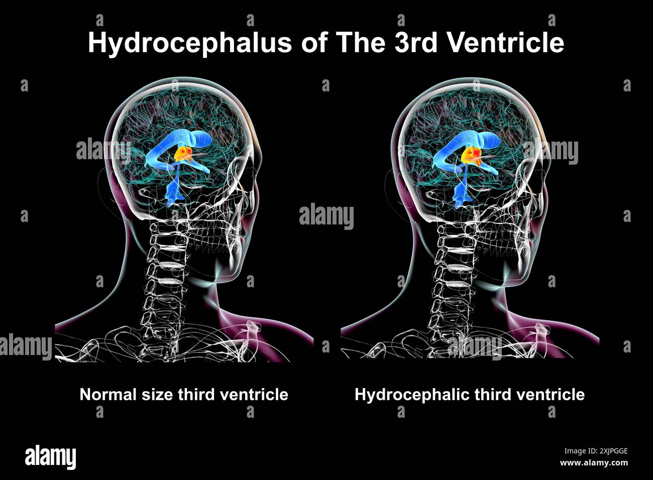 Illustration depicting isolated enlargement of the third brain ...