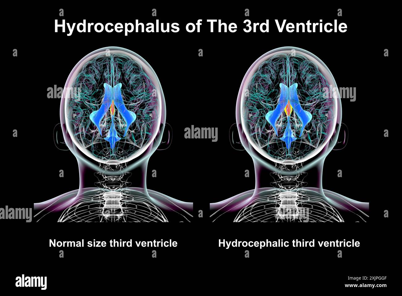 Illustration depicting isolated enlargement of the third brain ...