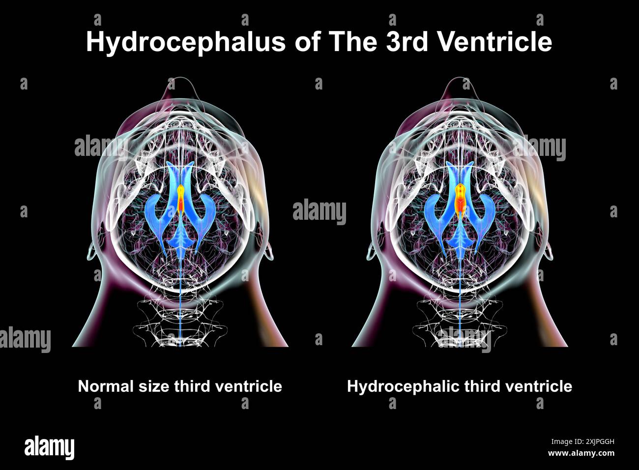 Illustration depicting isolated enlargement of the third brain ventricle (right) compared to the ...