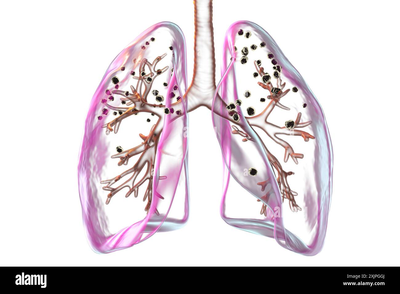 Illustration of lungs affected by silicosis, revealing dark silicotic ...