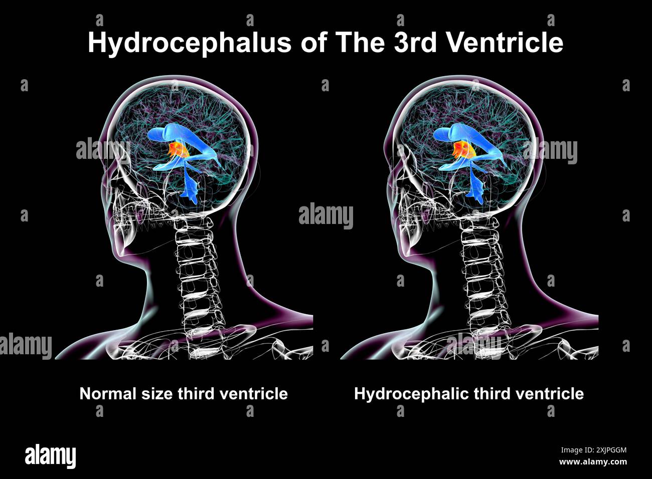 Illustration depicting isolated enlargement of the third brain ...