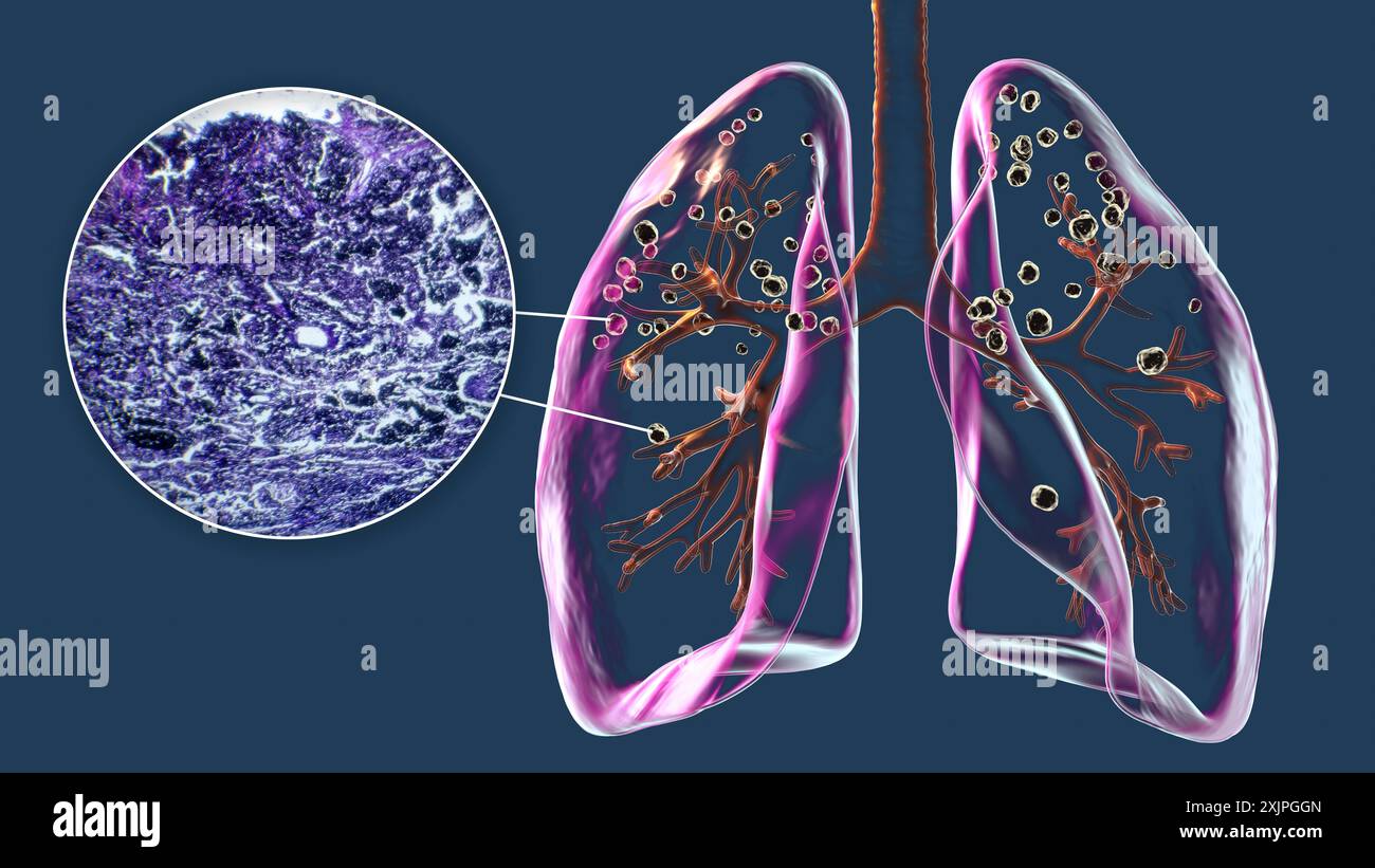 Illustration depicting lungs affected by silicosis, revealing dark ...